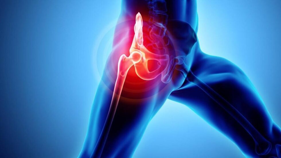Hip Bursitis | Lafayette Bone & Joint Clinic